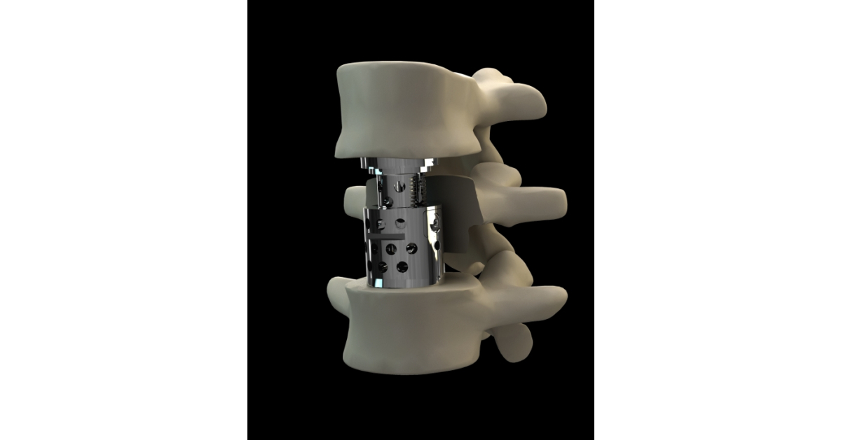 GIZA Vertebral Body Replacement from Eden Spine, LLC - PR.com